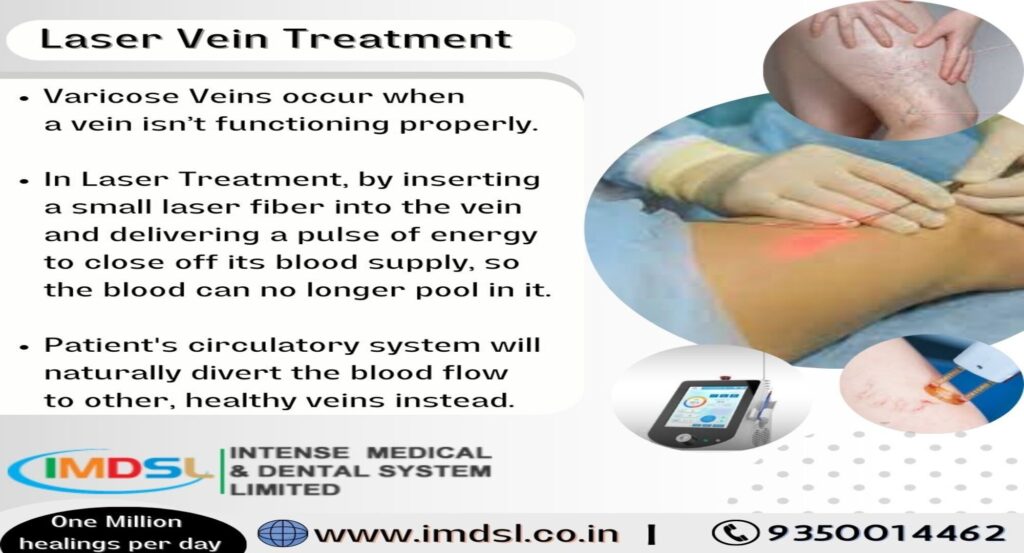Laser for Varicose Veins