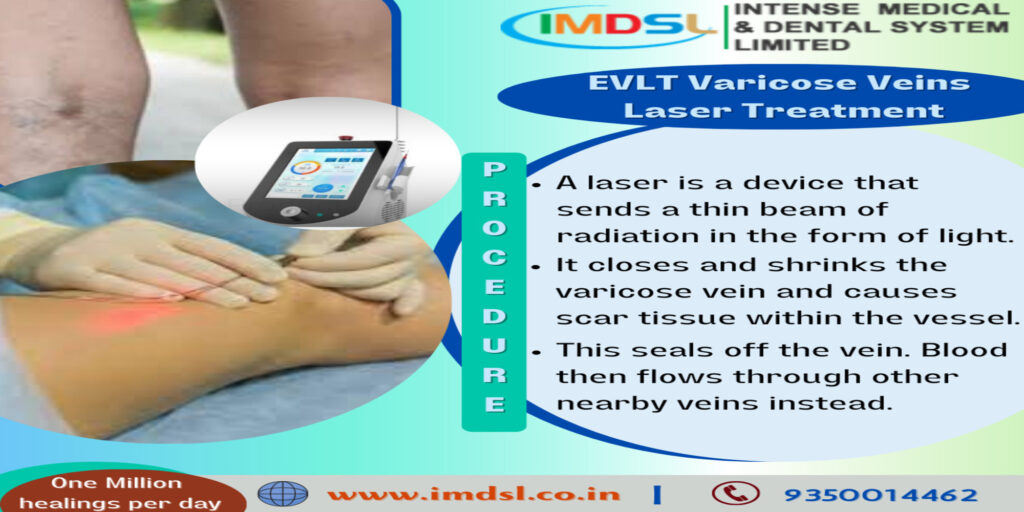 Effective Treatment for Varicose Veins using Laser